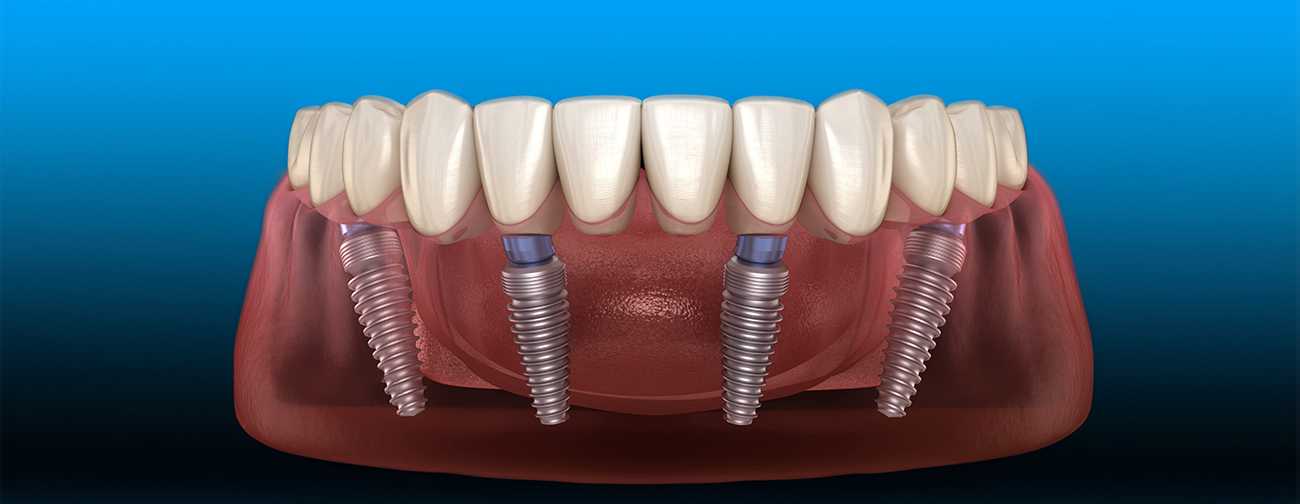 All-On-4s Dental Implants – Dentists Stevenson Ranch CA